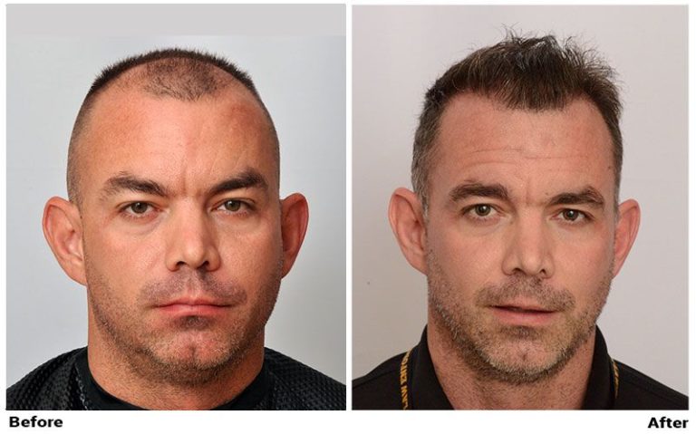 Hair Transplant Before And After | ForHair Hair Transplant Results