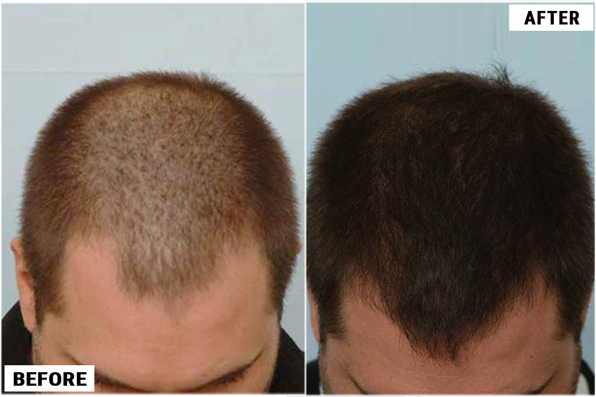 Fue Hair Transplant 2202 Grafts Before And After Photos Forhair