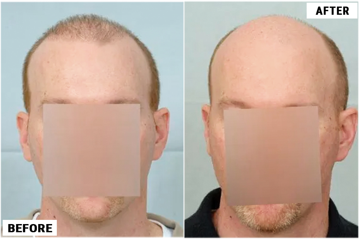 Hair Plug Removal Journey | Forhair Before & After Photos