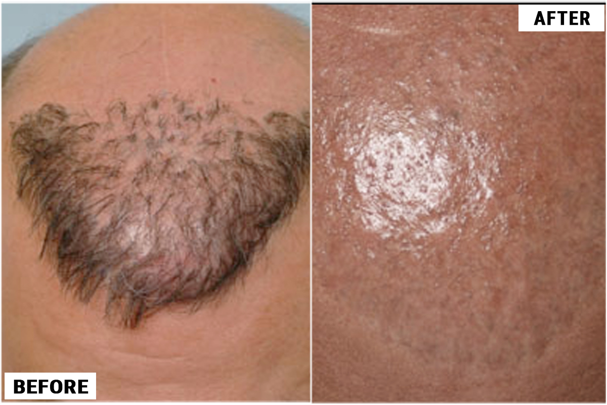Hair Plug Removal Results | Forhair Before & After Photos