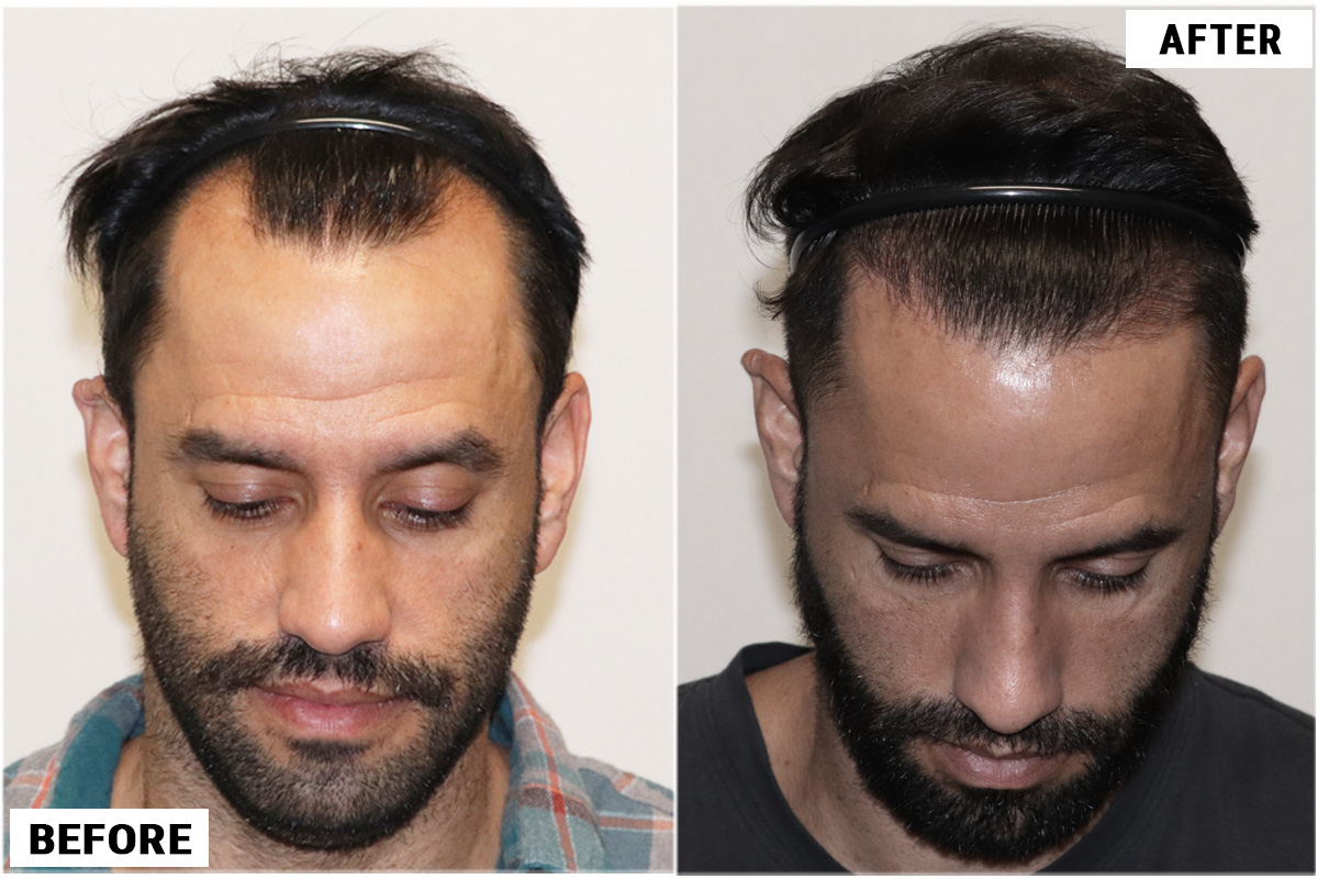 2930 Grafts Hair Restoration | Forhair Before & After Photos