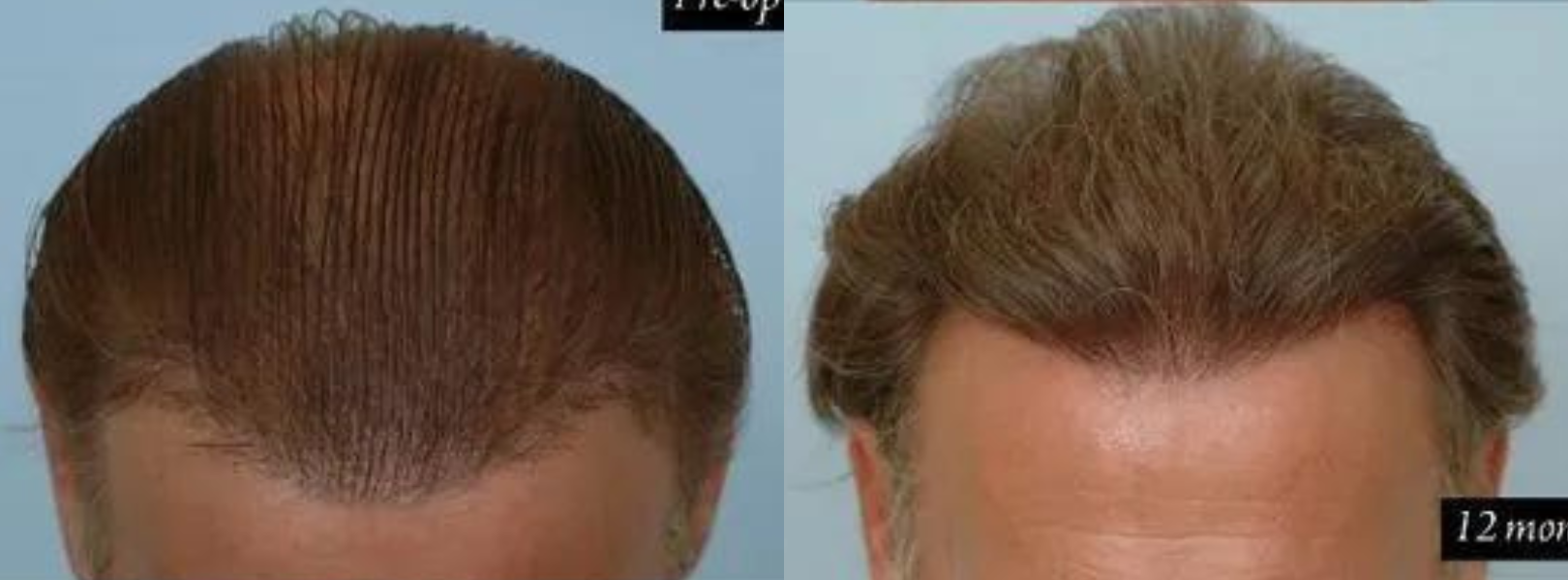 Hair Plug Redistribution Success | 541 Grafts Before & After Photos