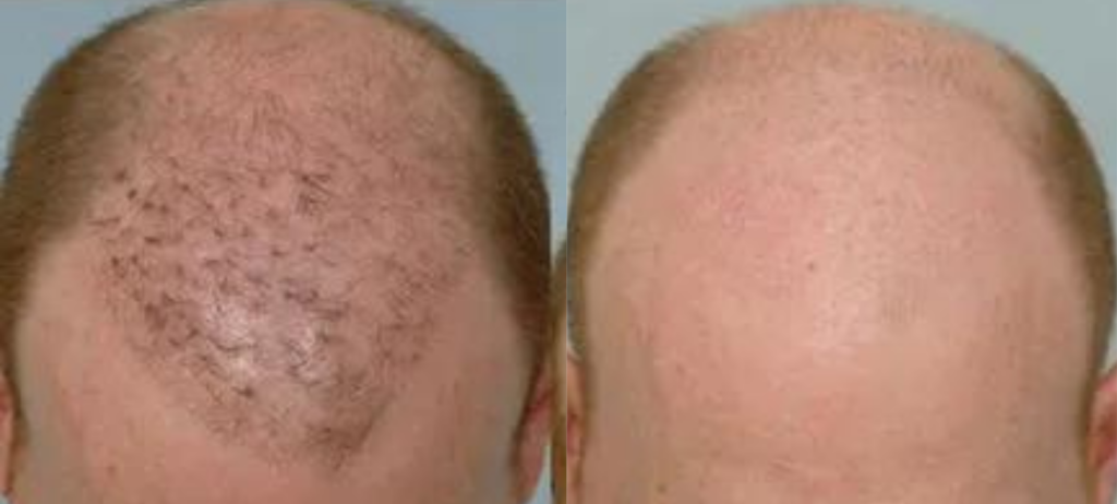 Hair Plug Removal Journey | Forhair Before & After Photos