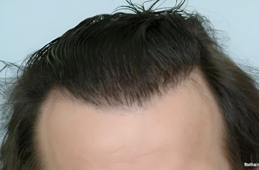 Hair Plug Redistribution Results | Forhair Before & After Photos