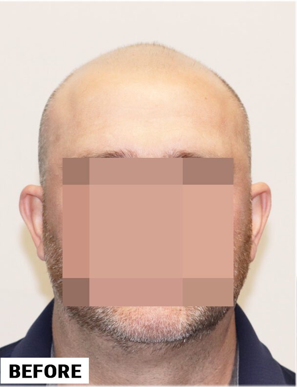 Great Hair Transplant Results | 5400 Grafts Before & After Photos