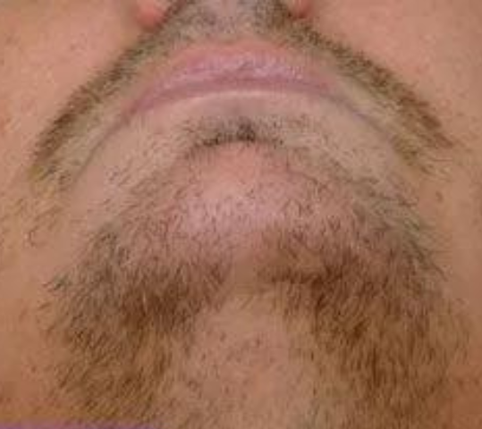 Hair Transplant Before And After | ForHair Hair Transplant Results