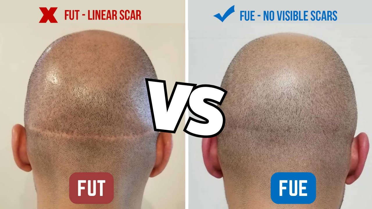 FUT vs FUE Hair Transplant Method - Which One is Better? Forhair