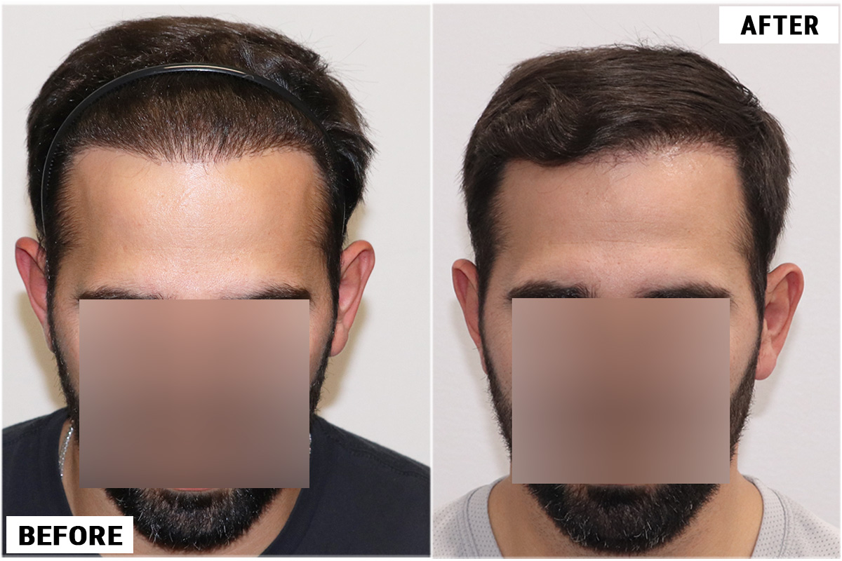 Hair Plug Removal #4 | Forhair Before & After Photos